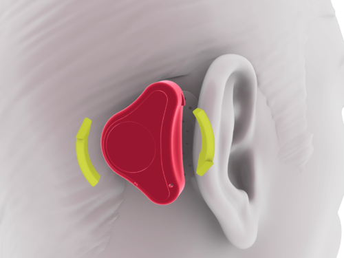 ADHEAR Tips & Tricks for Professionals - MED-EL Professionals Blog