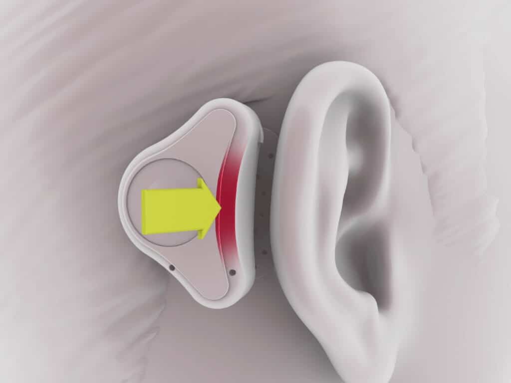 ADHEAR Tips & Tricks for Professionals - MED-EL Professionals Blog