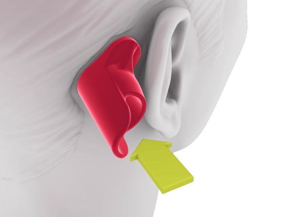 ADHEAR Tips & Tricks for Professionals - MED-EL Professionals Blog