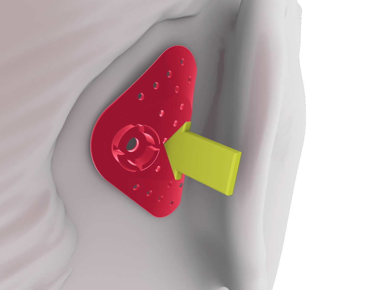 ADHEAR Tips & Tricks for Professionals - MED-EL Professionals Blog