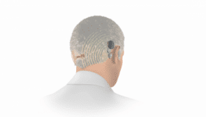 Bone Conduction Solutions for Single-Sided Deafness: ADHEAR ...