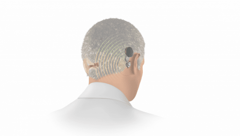 Bone Conduction Solutions for Single-Sided Deafness: ADHEAR ...