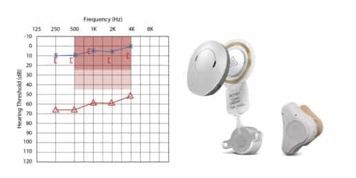 Air Conduction vs. Bone Conduction: Candidacy Guide for Bone Conduction ...