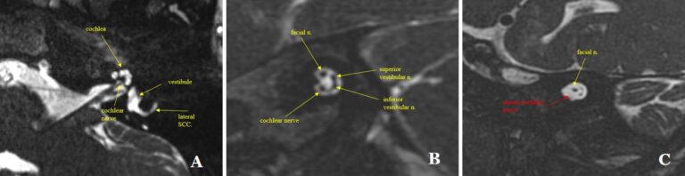 Importance of Safe MRI Access in Cochlear Implants: Dr. Nancy M. Young ...
