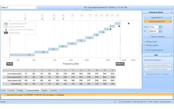 The MED-EL Spotlight: Implementing Anatomy-Based Fitting into Your ...