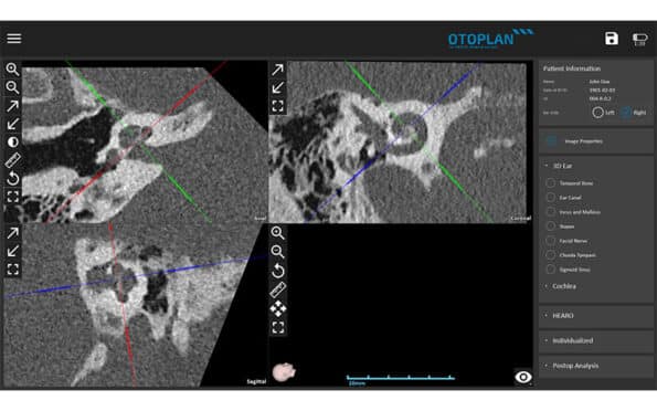 The MED-EL Spotlight: Implementing Anatomy-Based Fitting into Your ...