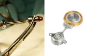 Replacing BAHA With BCI 602: Surgeons Agree on International Guidelines ...