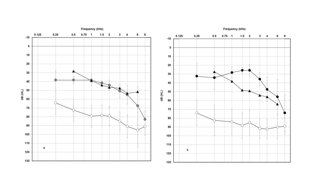 VIBRANT SOUNDBRIDGE: The Better Solution for Mixed Hearing Loss? - MED ...