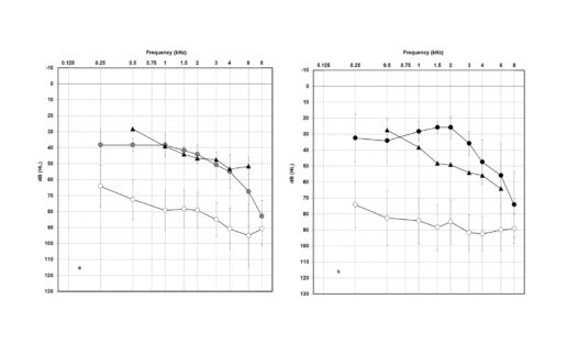 VIBRANT SOUNDBRIDGE: The Better Solution for Mixed Hearing Loss? - MED ...
